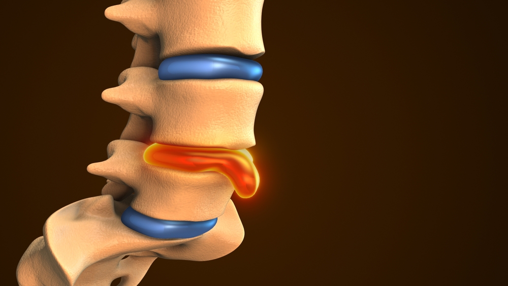 Does A Bulging Disc Ever Heal Itself? "Follow Therapy"