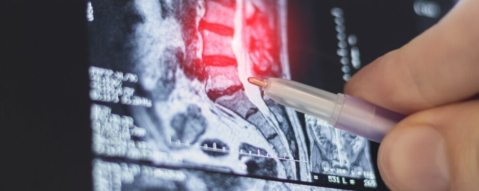 What Happens If A Herniated Disc Is Left Untreated? "Act Early"